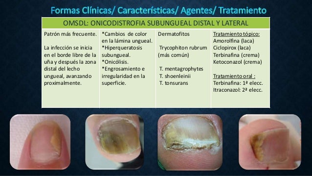 Patologías Ungueales: Onicocriptosis, Onicomicosis y Onicogrifosis.
