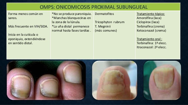 Patologías Ungueales: Onicocriptosis, Onicomicosis y Onicogrifosis.
