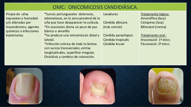 Patologías Ungueales: Onicocriptosis, Onicomicosis y Onicogrifosis.