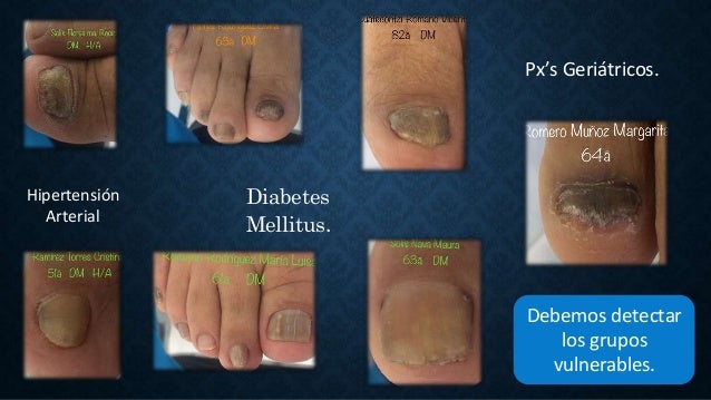 Patologías Ungueales: Onicocriptosis, Onicomicosis y Onicogrifosis.