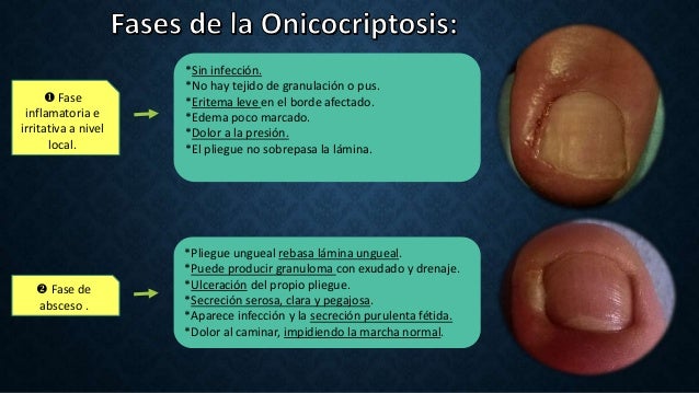Patologías Ungueales: Onicocriptosis, Onicomicosis y Onicogrifosis.