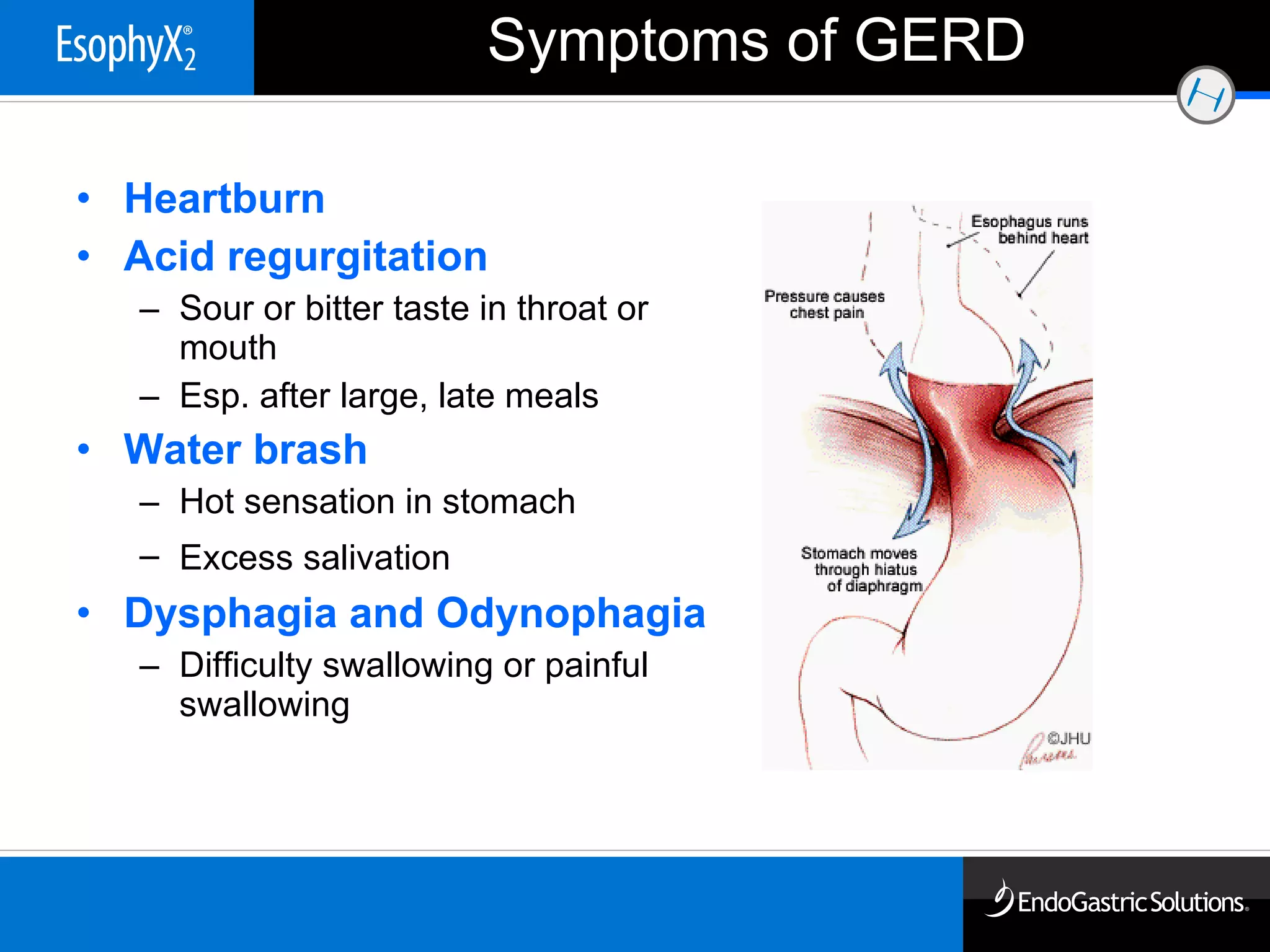 Patient info for TIF/endoscopic gastric fundoplication