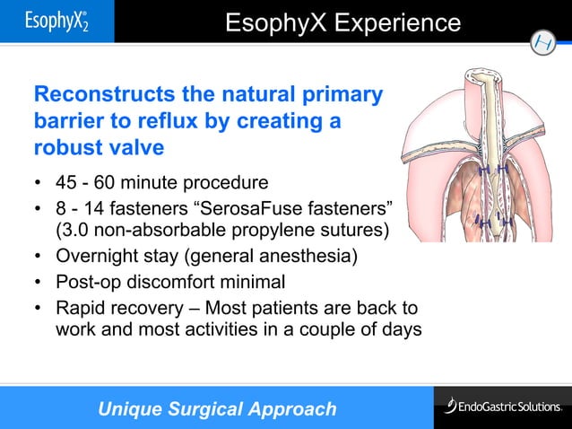Patient info for TIF/endoscopic gastric fundoplication | PPT