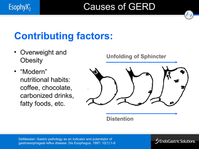 Patient info for TIF/endoscopic gastric fundoplication | PPT