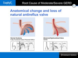 Patient info for TIF/endoscopic gastric fundoplication | PPT