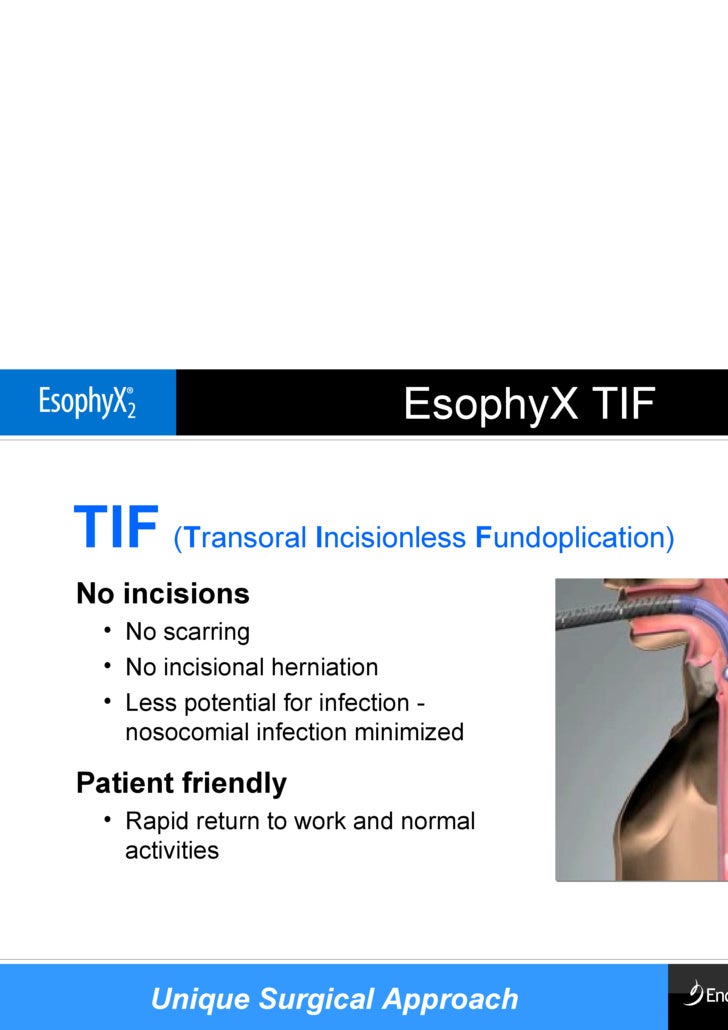 Patient info for TIF/endoscopic gastric fundoplication