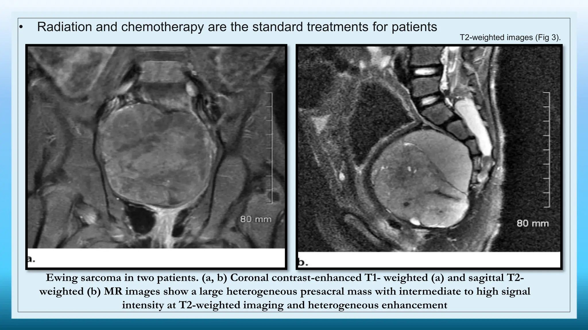 pre sacral lesion sept5.pptx RADIOLOGY | PPTX