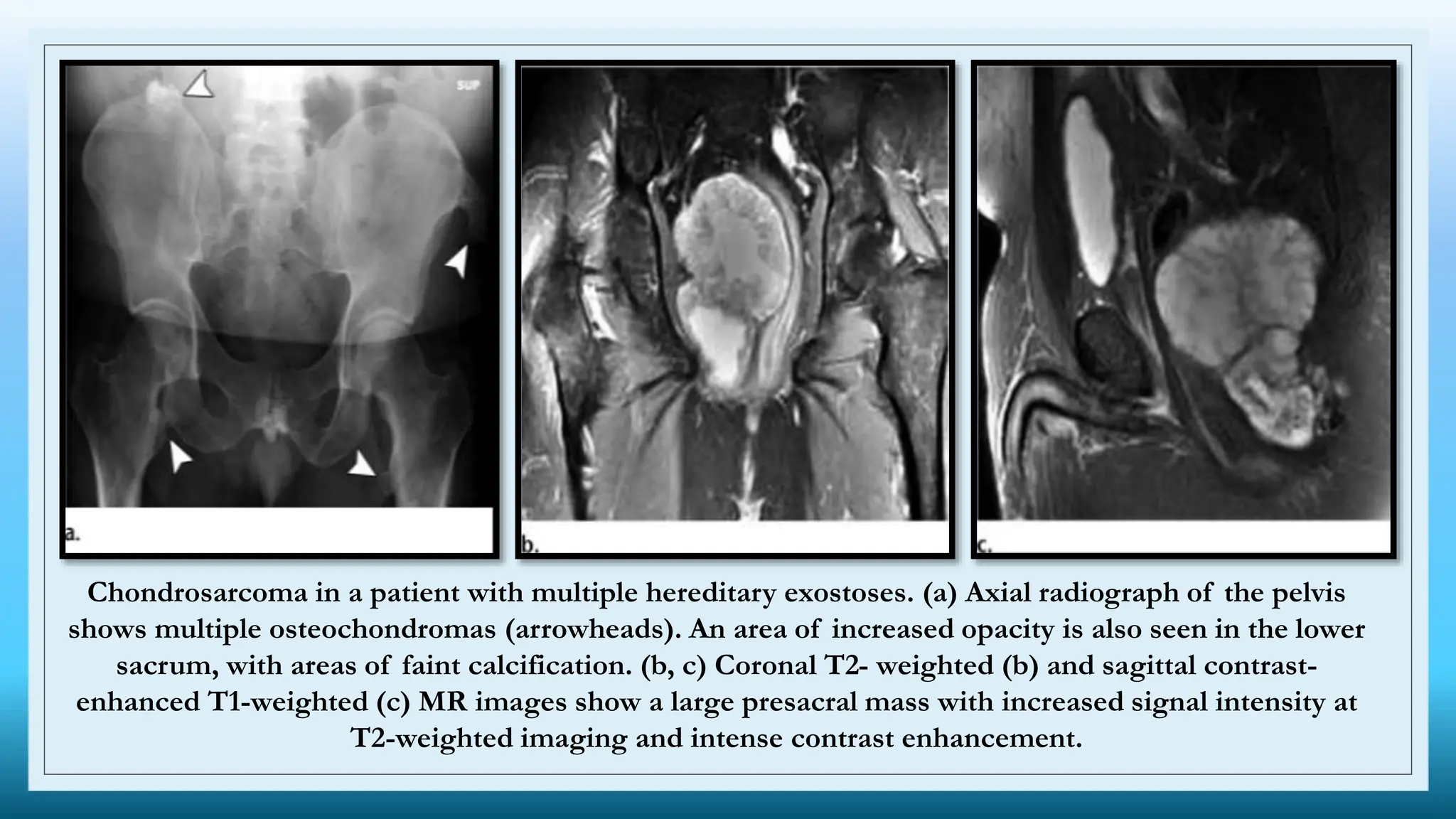 pre sacral lesion sept5.pptx RADIOLOGY | PPTX