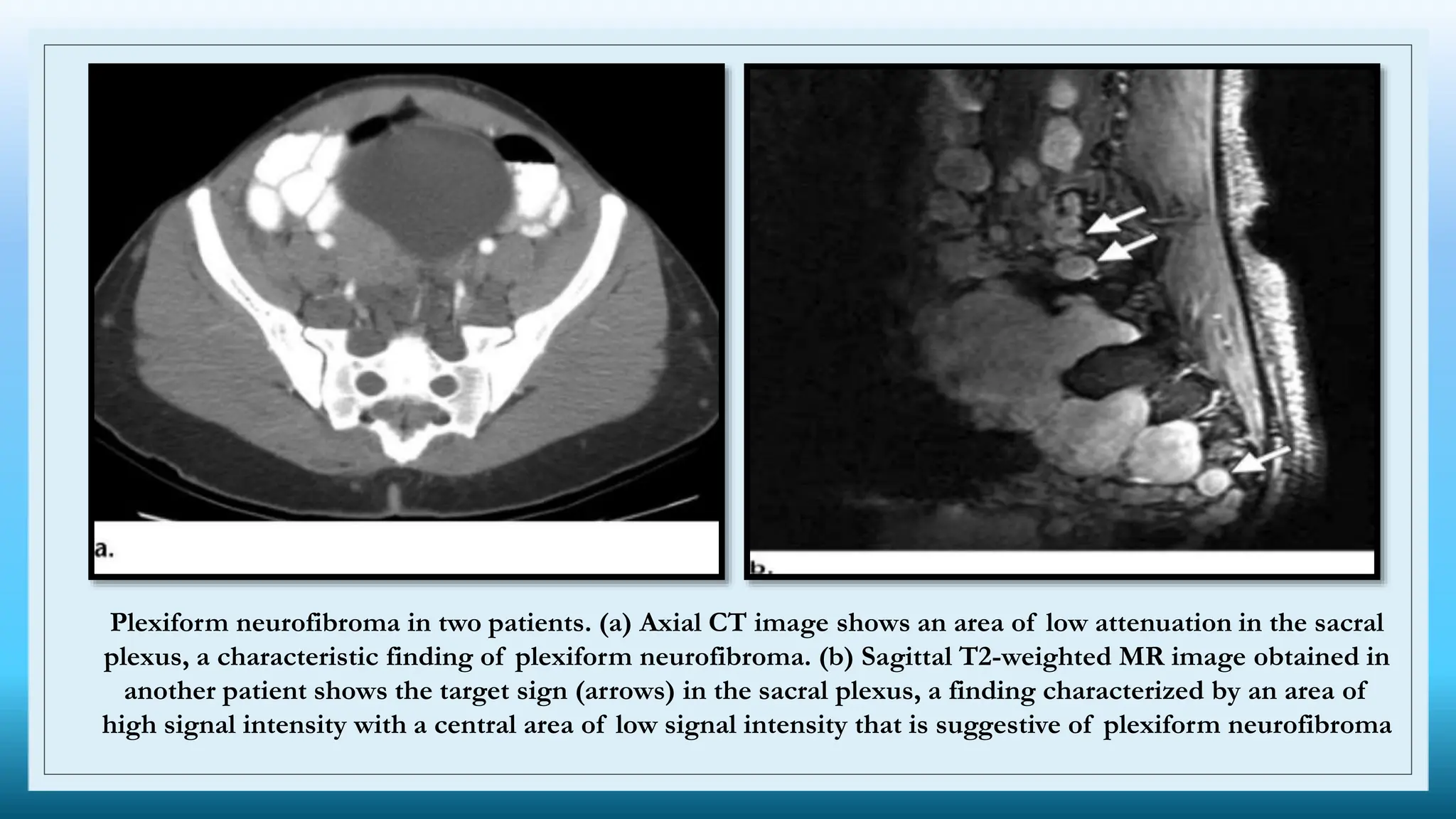 pre sacral lesion sept5.pptx RADIOLOGY | PPTX