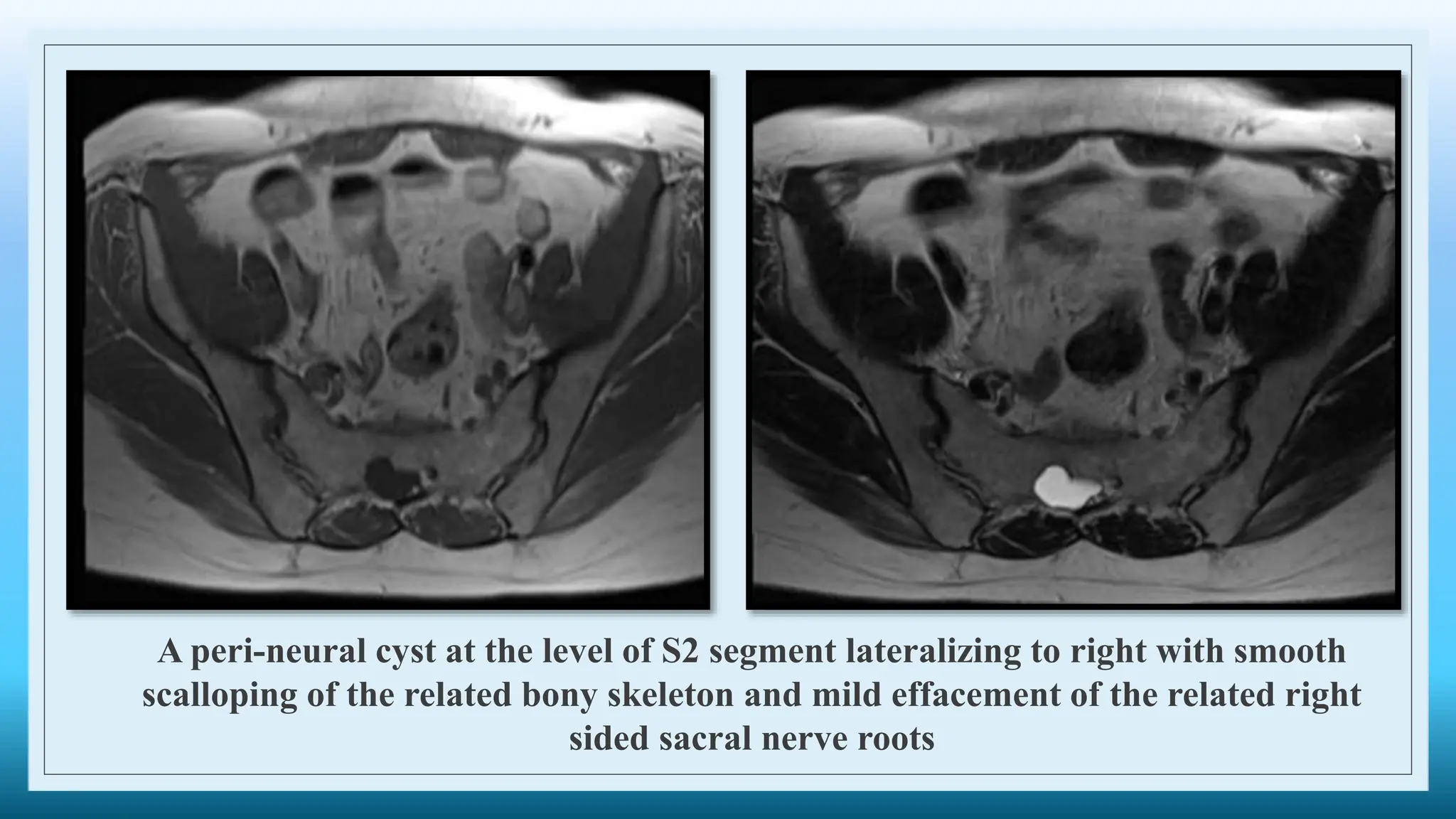 pre sacral lesion sept5.pptx RADIOLOGY | PPTX