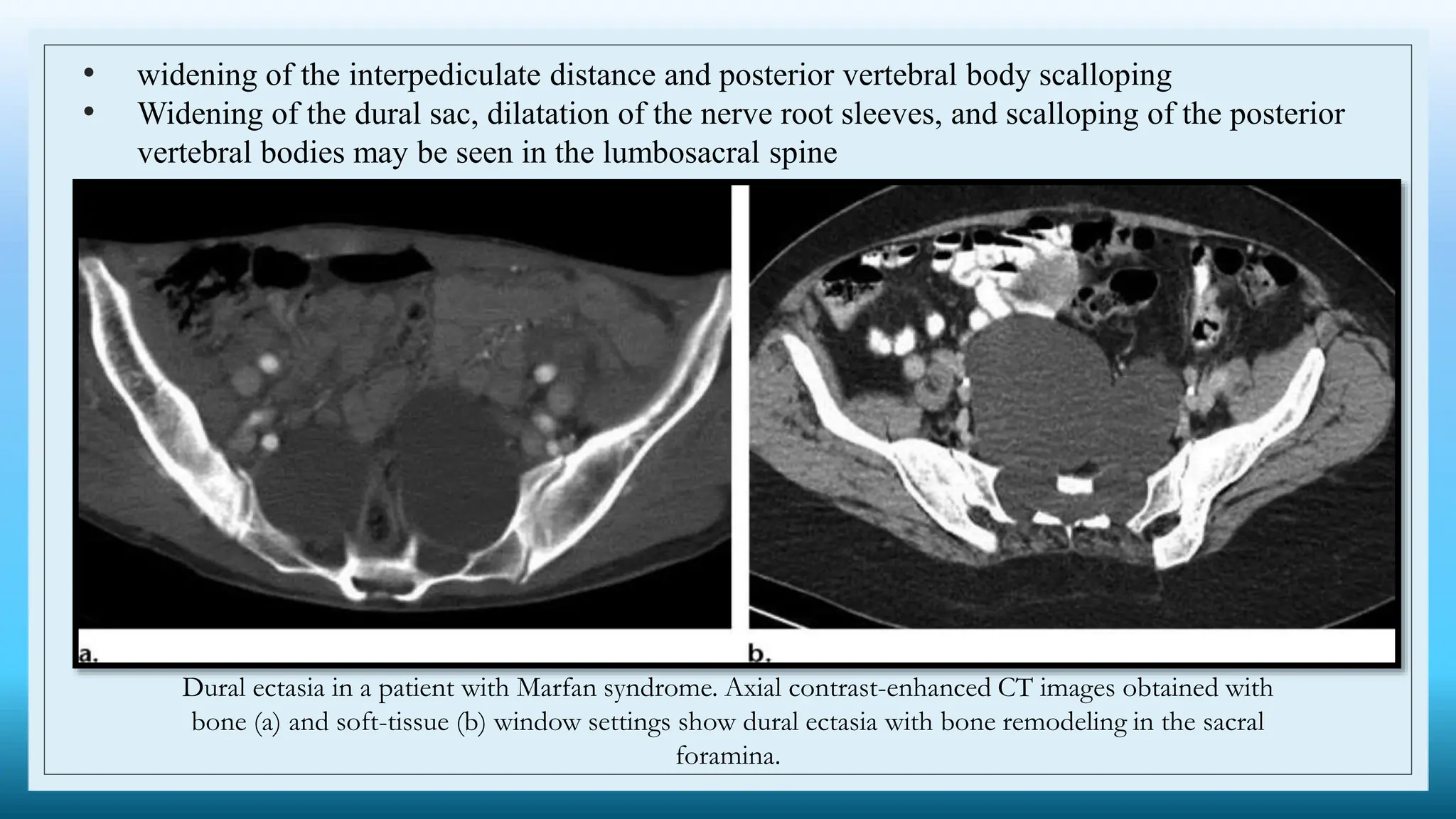 pre sacral lesion sept5.pptx RADIOLOGY | PPTX