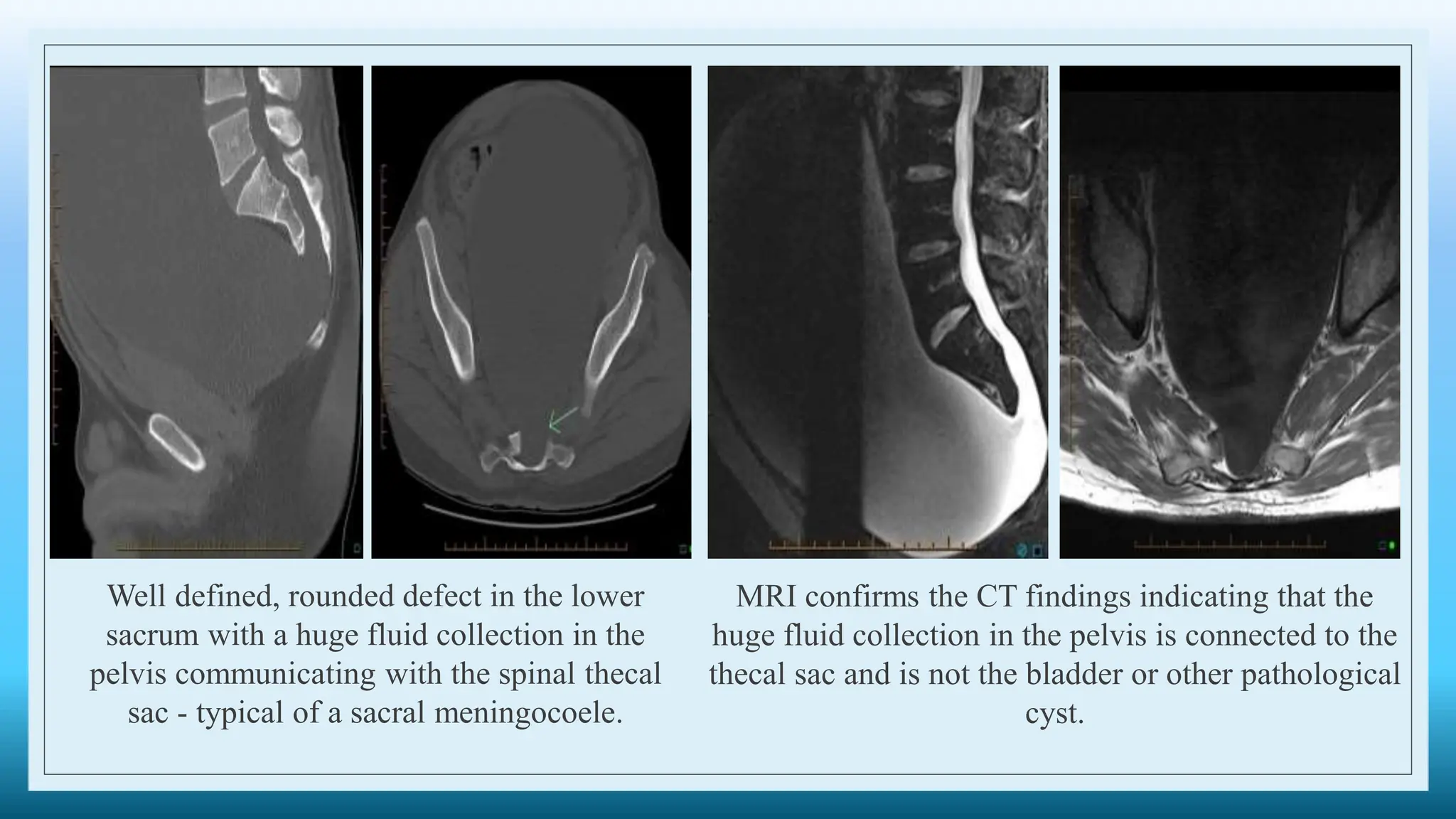 pre sacral lesion sept5.pptx RADIOLOGY | PPTX