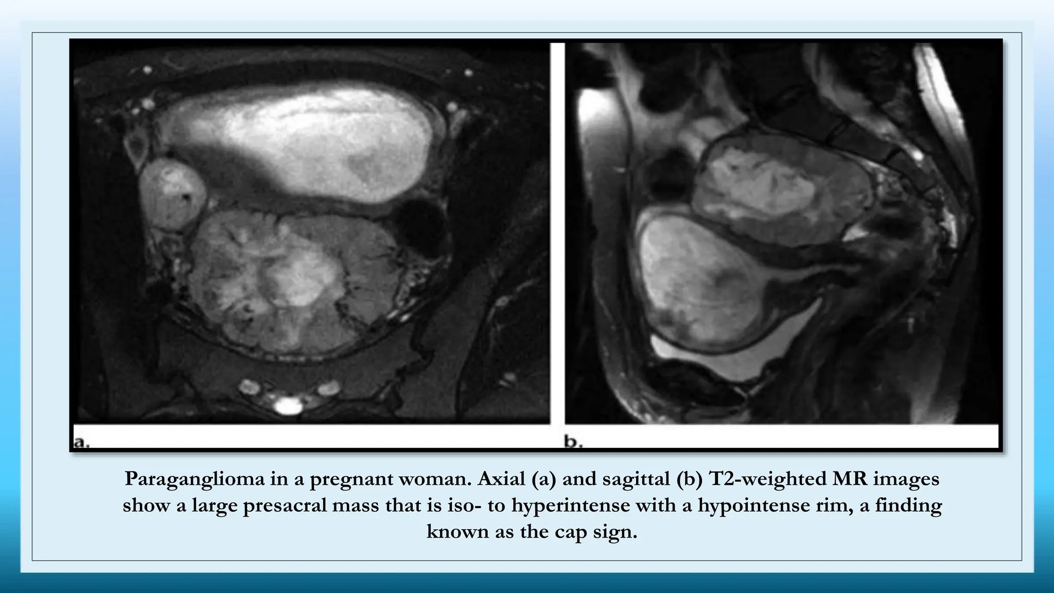 pre sacral lesion sept5.pptx RADIOLOGY | PPTX