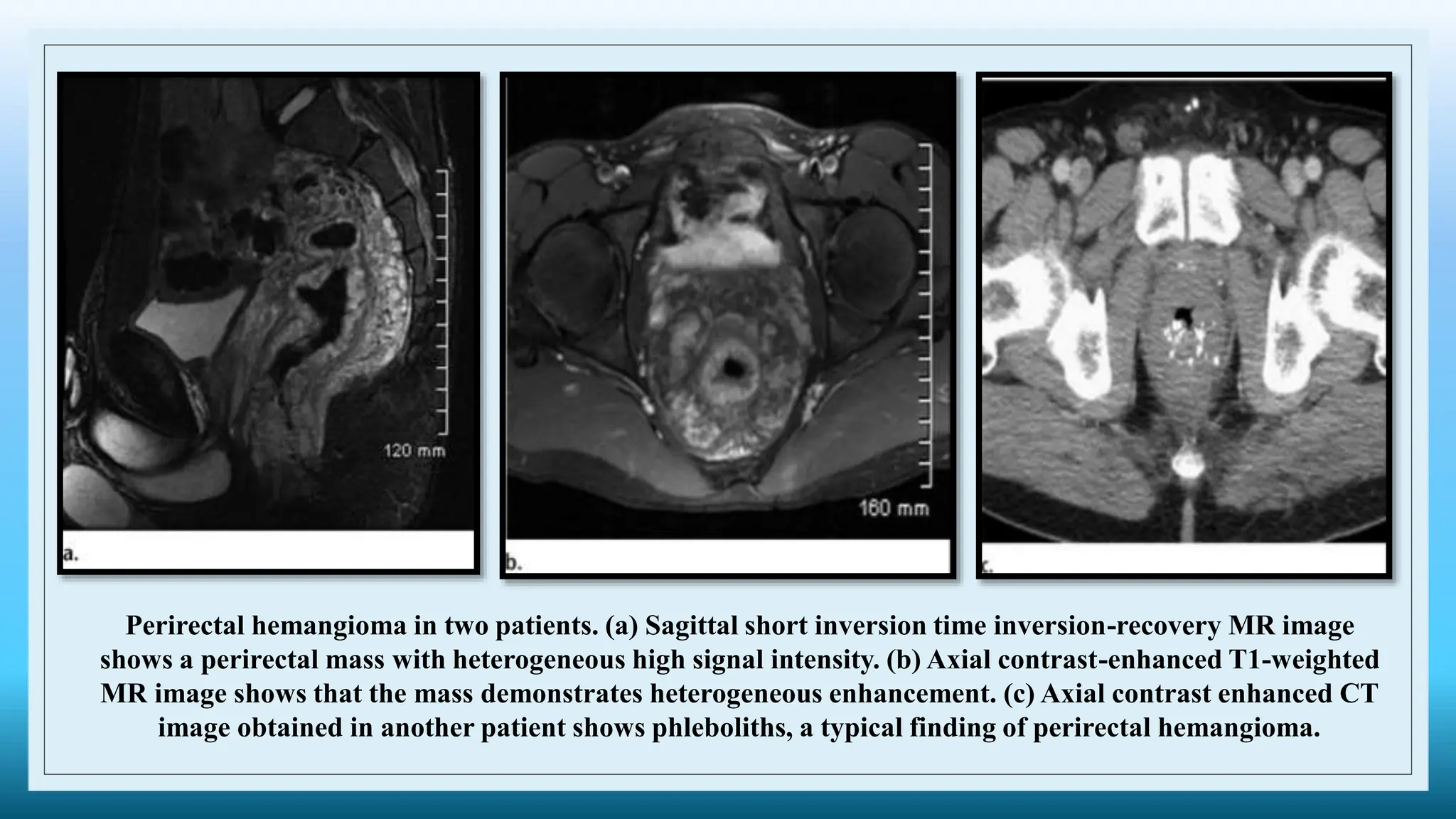pre sacral lesion sept5.pptx RADIOLOGY | PPTX