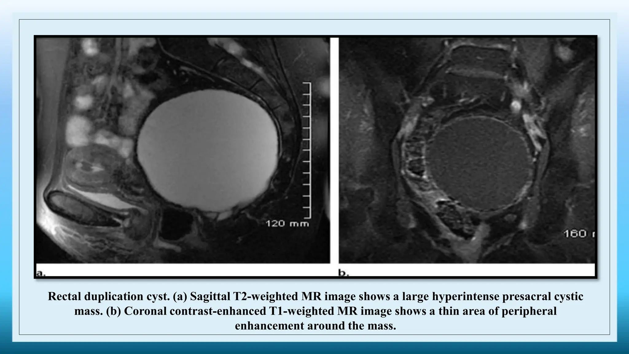pre sacral lesion sept5.pptx RADIOLOGY | PPTX