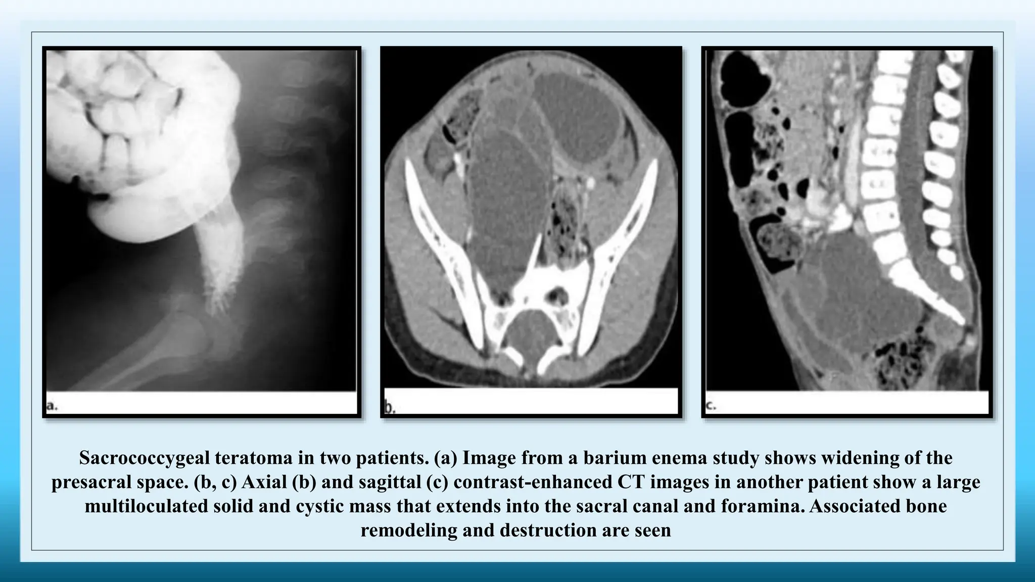 pre sacral lesion sept5.pptx RADIOLOGY | PPTX