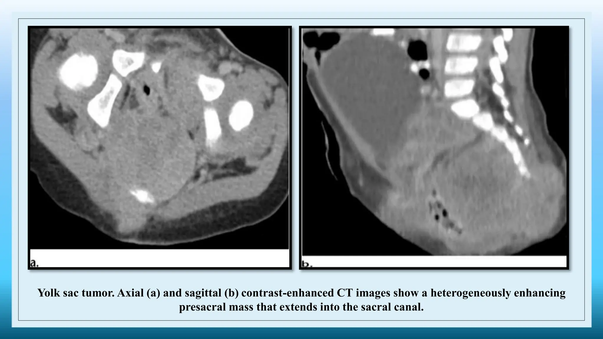 pre sacral lesion sept5.pptx RADIOLOGY | PPTX