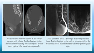 pre sacral lesion sept5.pptx RADIOLOGY | PPTX