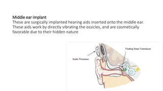 Presbycusis | PPTX