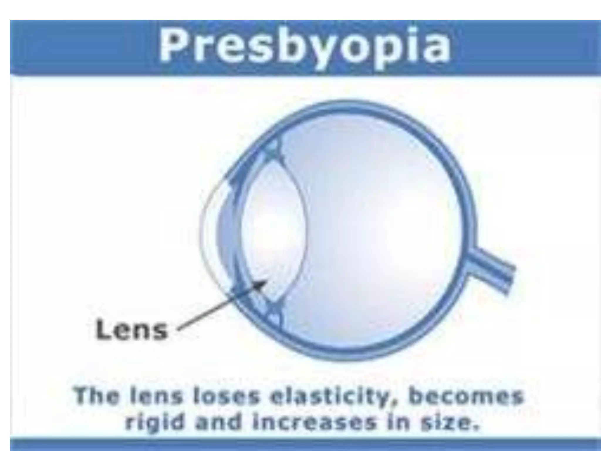 Presbyopia | PPT