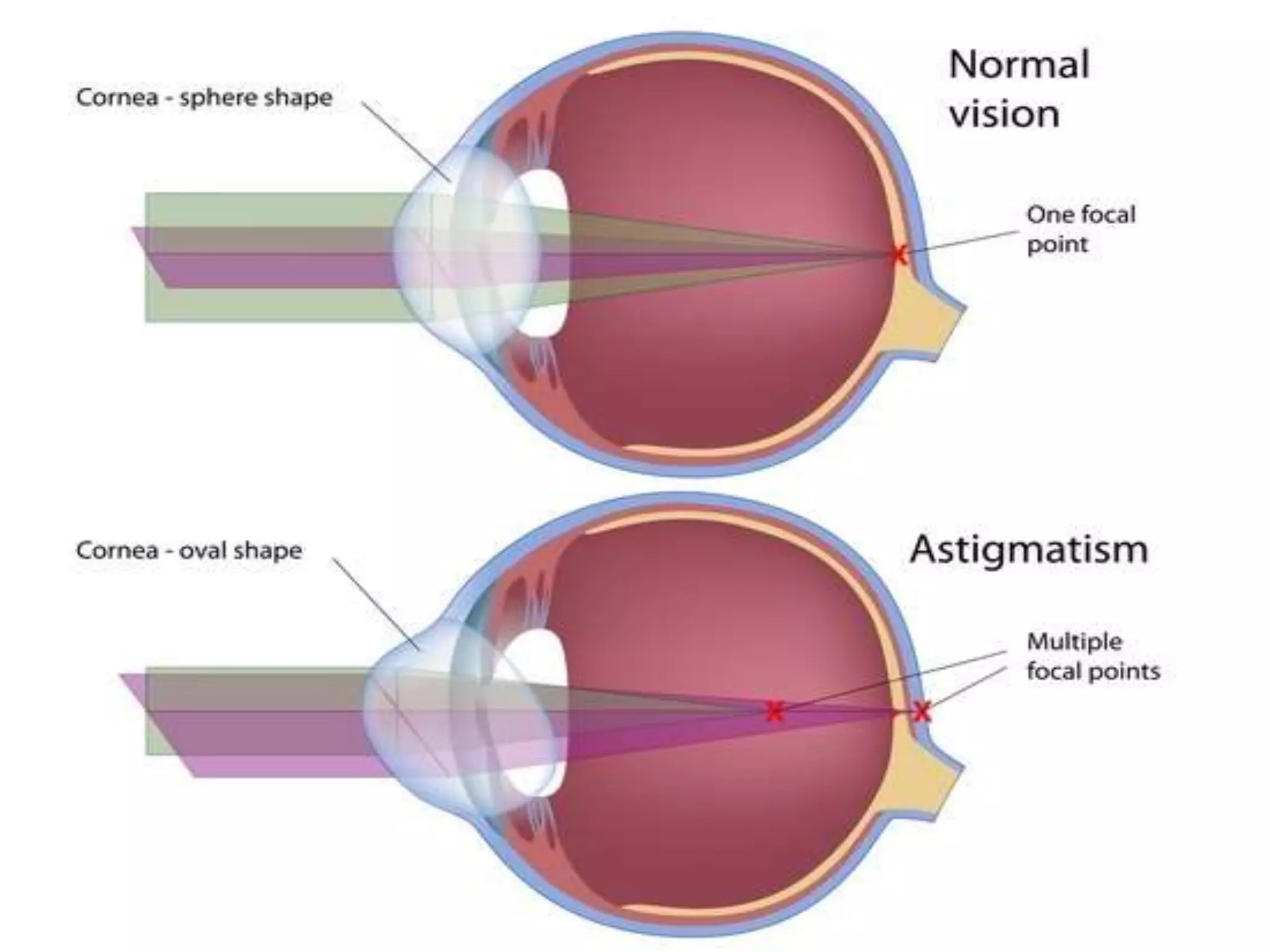 Presbyopia | PPT