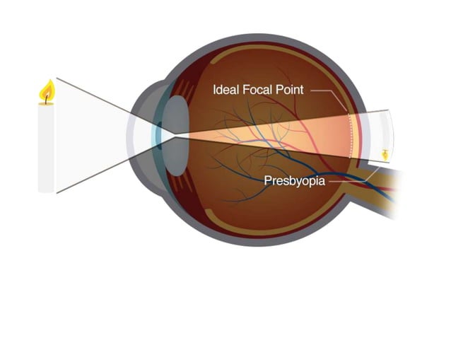 Presbyopia | PPTX | Eye and Vision Conditions | Diseases and Conditions