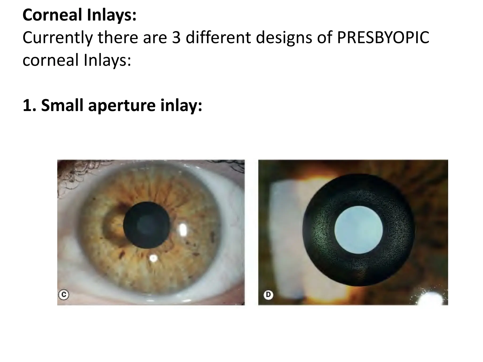 PRESBYOPIA the presentation ophthalmology | PDF