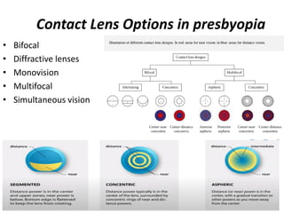 Presbyopic contact lens description | PPT