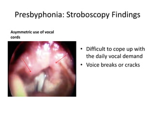 Presbyphonia aging & voice | PPTX