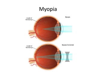 Prescribing for refractive errors - presentation at www.eyenirvaan.com