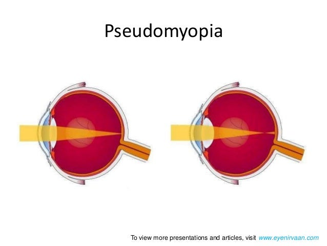 Prescribing for refractive errors - presentation at www.eyenirvaan.com