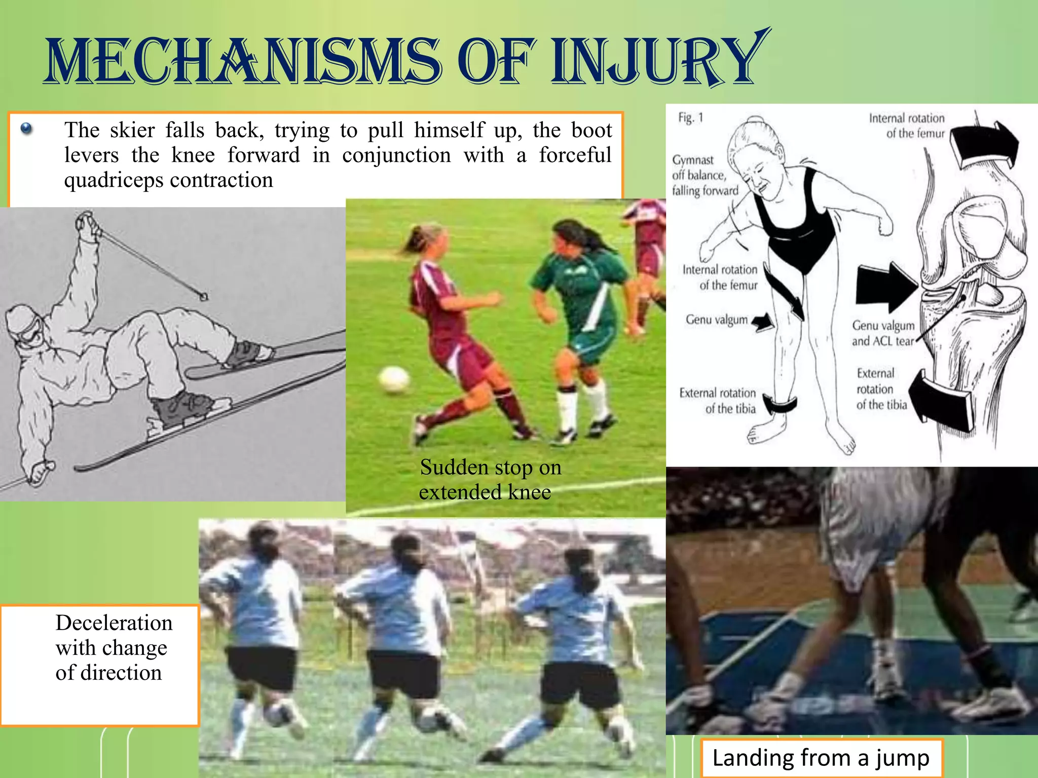 ACL rehabilitation | PPTX