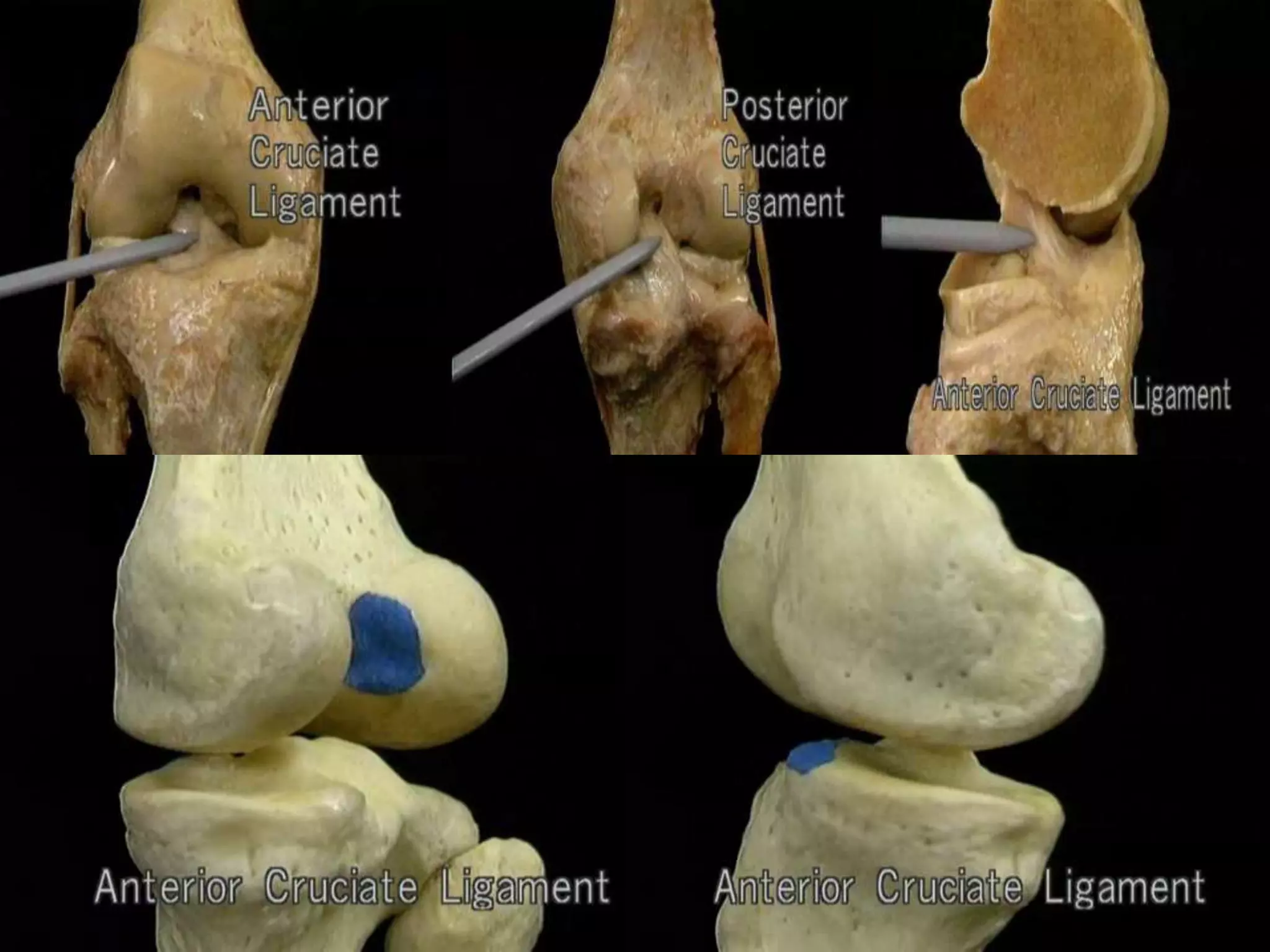 ACL rehabilitation | PPTX