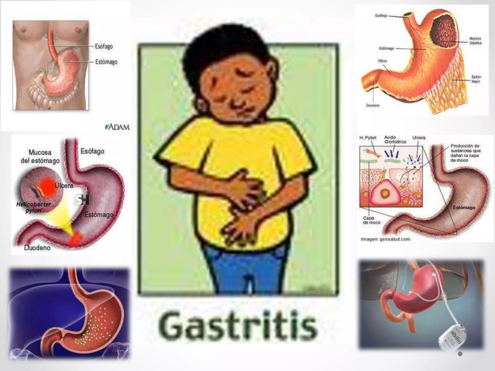 CASO CLINICO DE GASTRITIS | PPTX