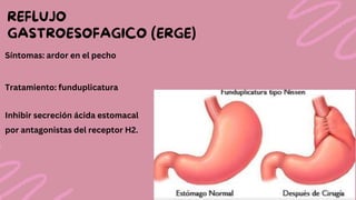 Esfinter Esofagico Inferior Anatomia Humana | PDF