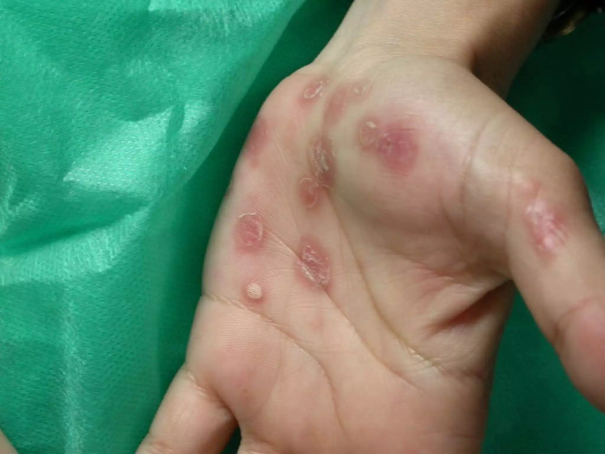 Lesions involving palms and soles | PPT