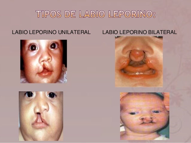 Labio Leporino Y Paladar Hendido