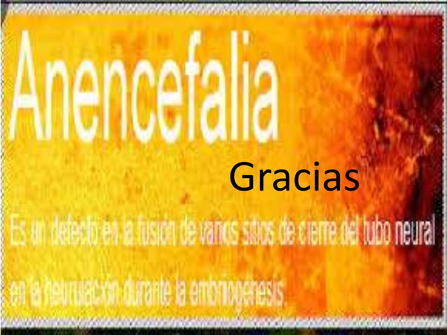 anencefalia | PPTX