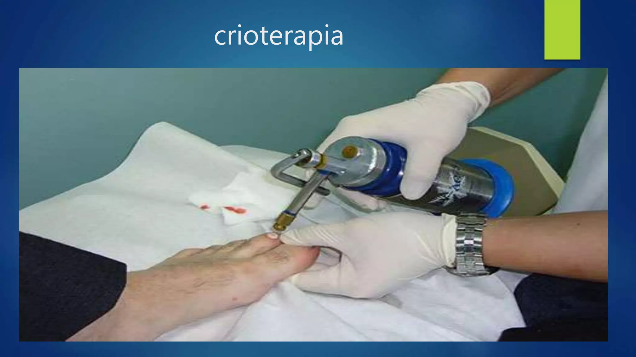 Quiste mucoide | PPTX