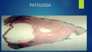 Quiste mucoide | PPTX