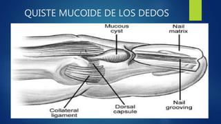 Quiste mucoide | PPTX