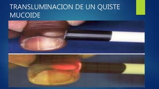 Quiste mucoide | PPTX