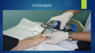 Quiste mucoide | PPTX