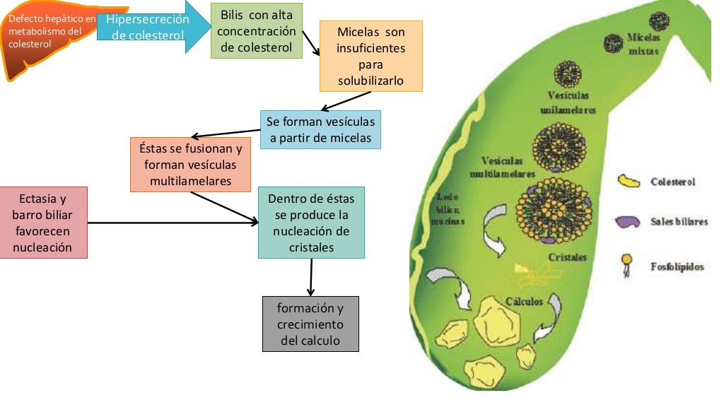 colelitiasis y complicaciones