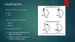 Hemorragia Digestiva Alta por Varices Esofagicas | PPTX