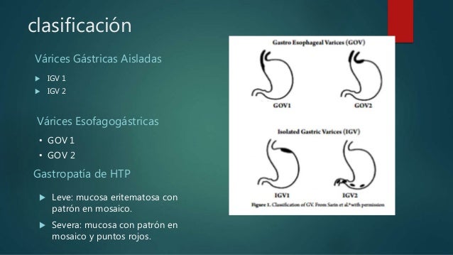 Hemorragia Digestiva Alta por Varices Esofagicas