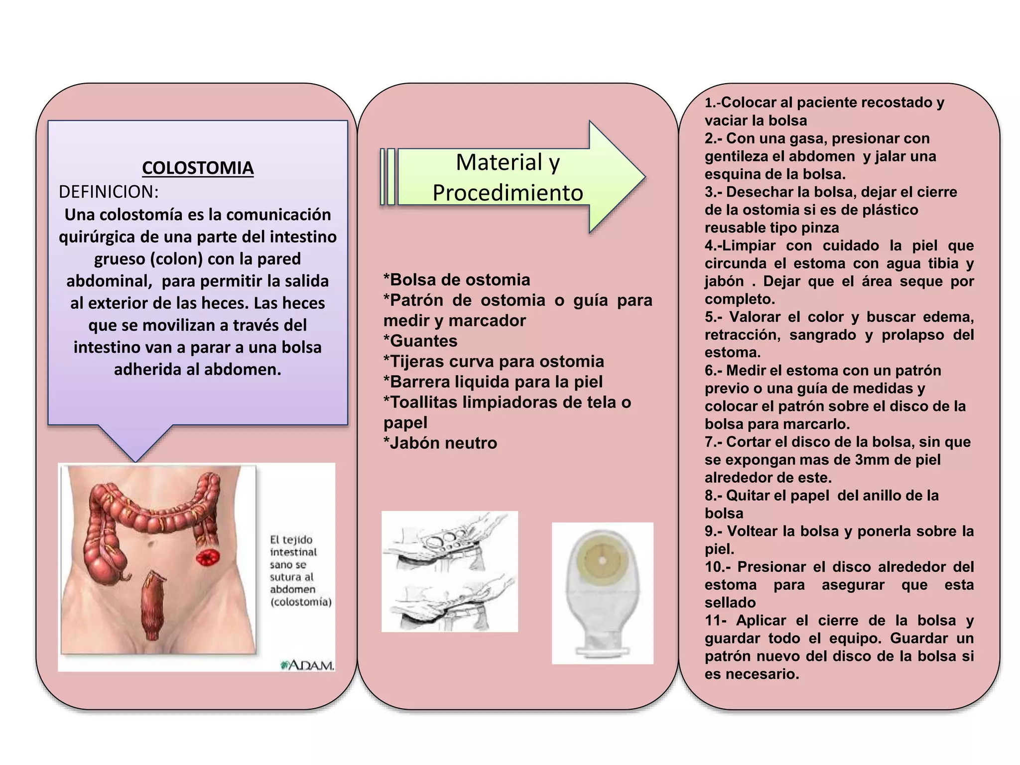 COLOSTOMIA | PPTX