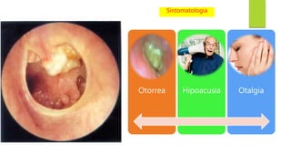 otitis medias crónicas | PPTX