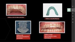 tipos de ferula | PPTX