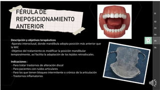 tipos de ferula | PPTX